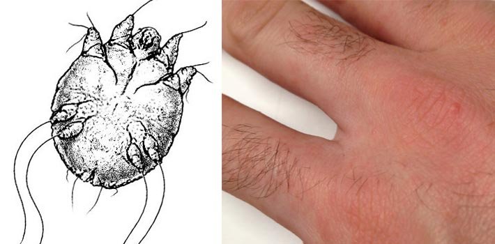 Home Remedies for Scabies - HealthDab